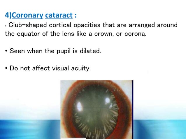 Embryology and developmental defects of lens | PPTX | Eye and Vision ...