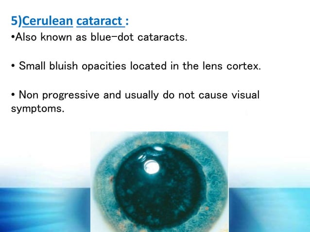 Embryology and developmental defects of lens | PPTX | Eye and Vision ...