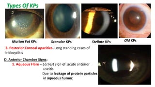 Uveitis | PPTX