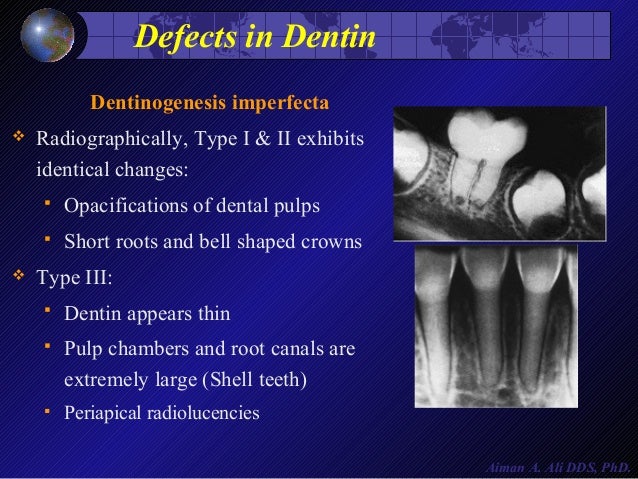 Dentin Dysplasia Vs Dentinogenesis Imperfecta