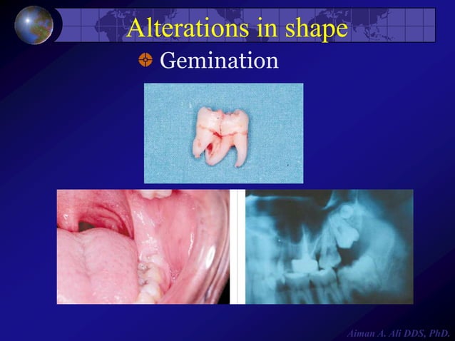 Opi 1-introduction-tooth abnormalities | PPT