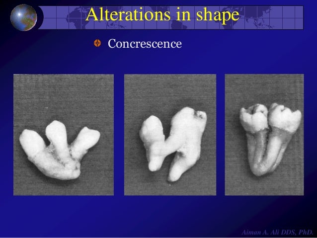 Opi 1-introduction-tooth abnormalities