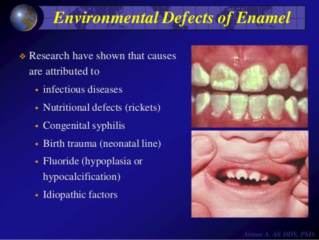 Opi 1-introduction-tooth abnormalities