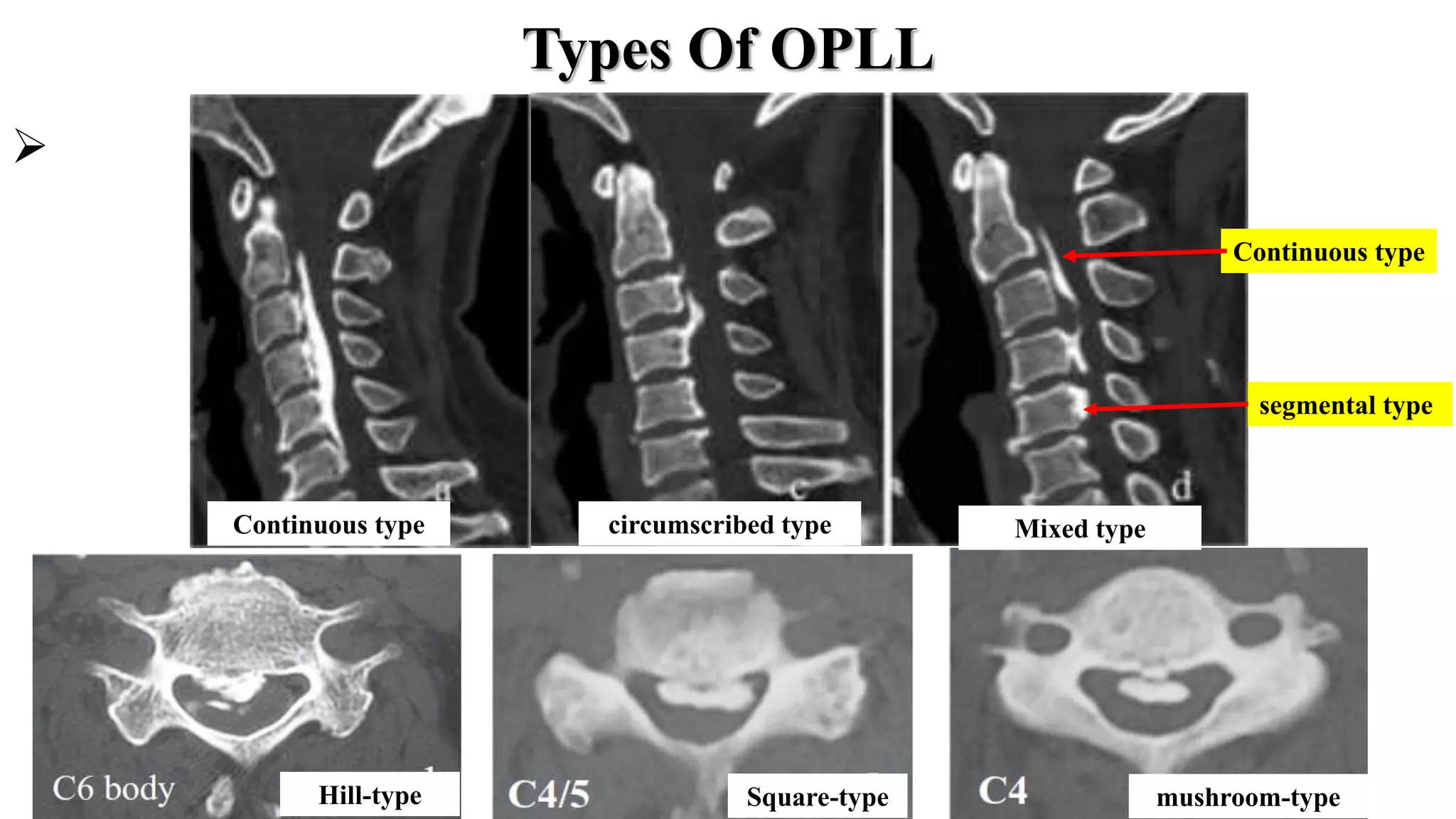 Ossified Posterior Longitudinal Ligament (OPLL) | PPTX
