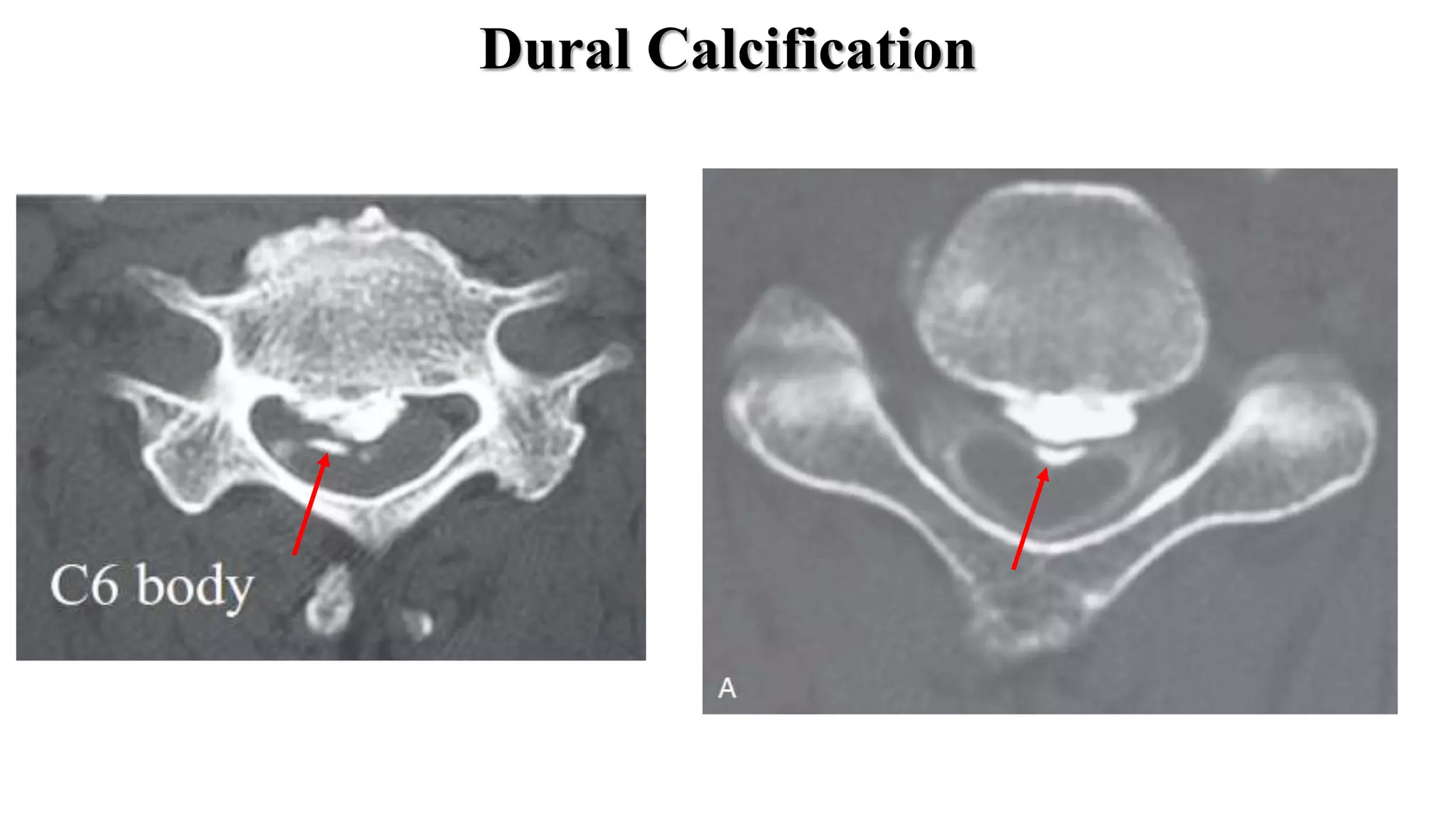 Ossified Posterior Longitudinal Ligament (OPLL) | PPTX