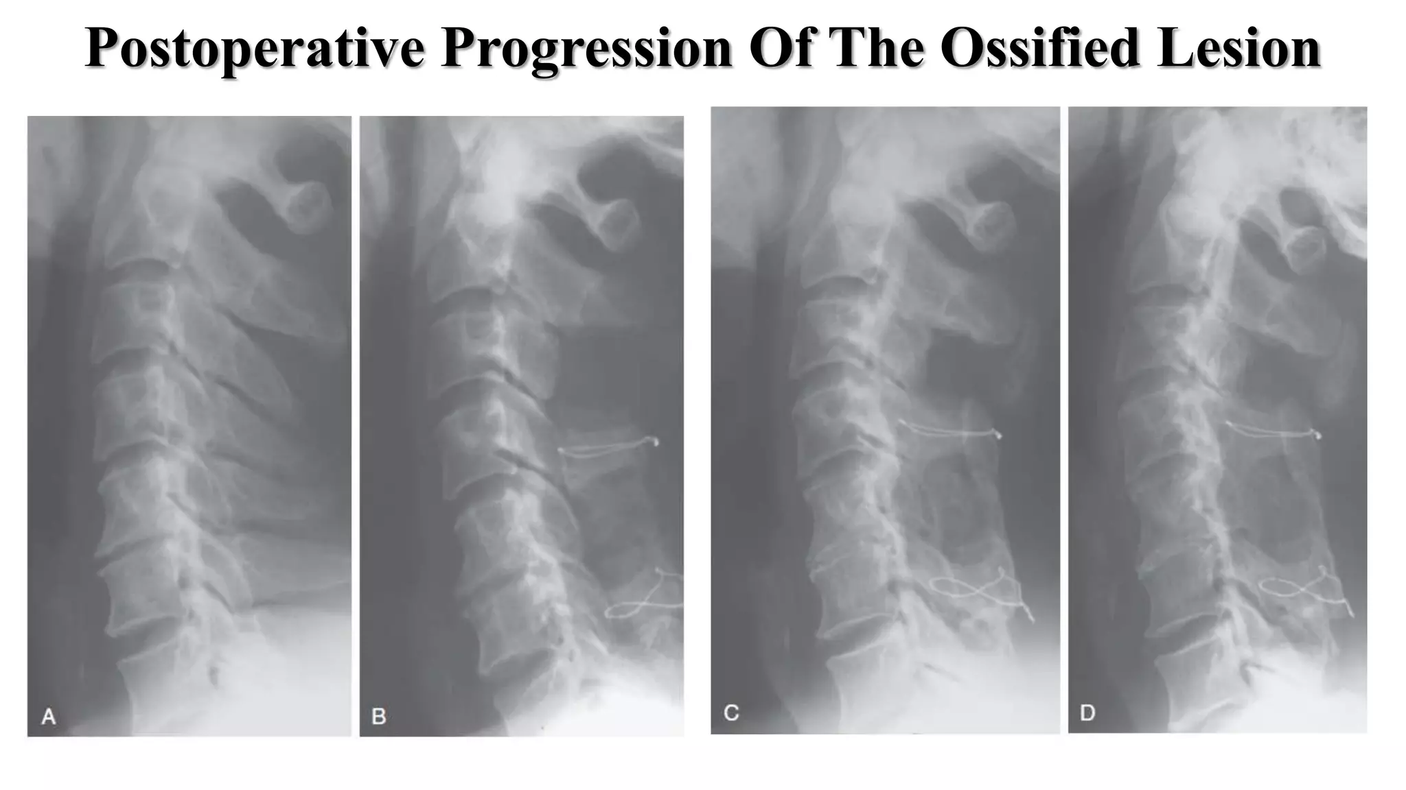 Ossified Posterior Longitudinal Ligament (OPLL) | PPTX