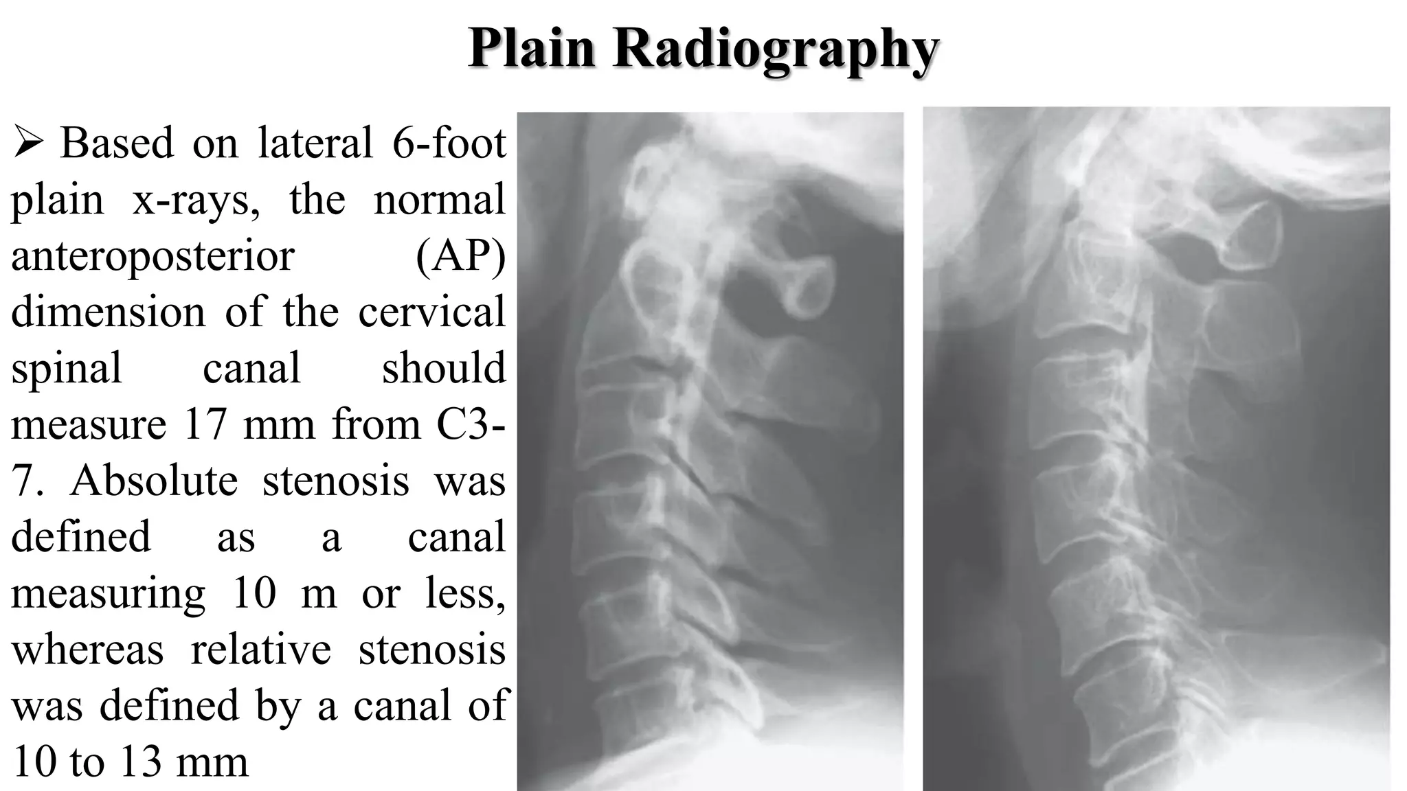 Ossified Posterior Longitudinal Ligament (OPLL) | PPTX | Bone and Joint ...
