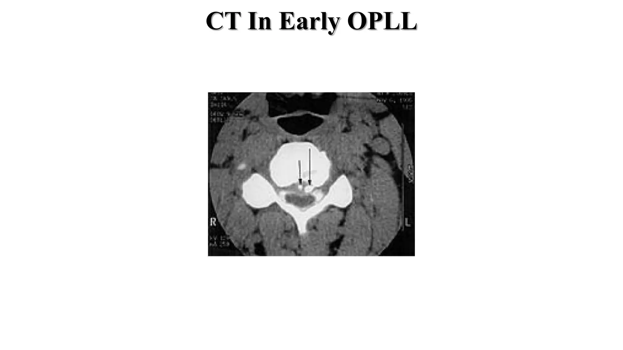 Ossified Posterior Longitudinal Ligament (OPLL) | PPTX | Bone and Joint ...
