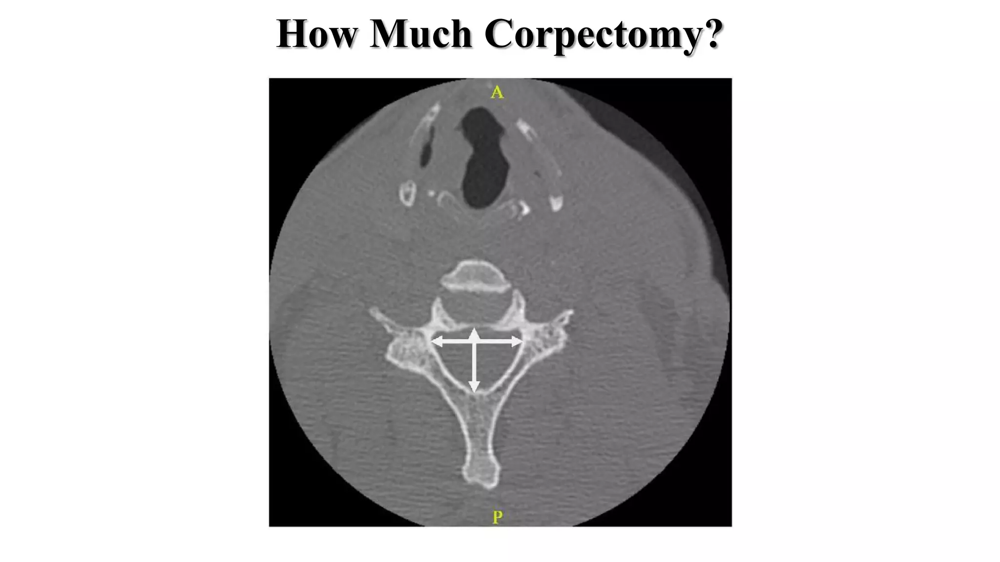 Ossified Posterior Longitudinal Ligament (OPLL) | PPTX