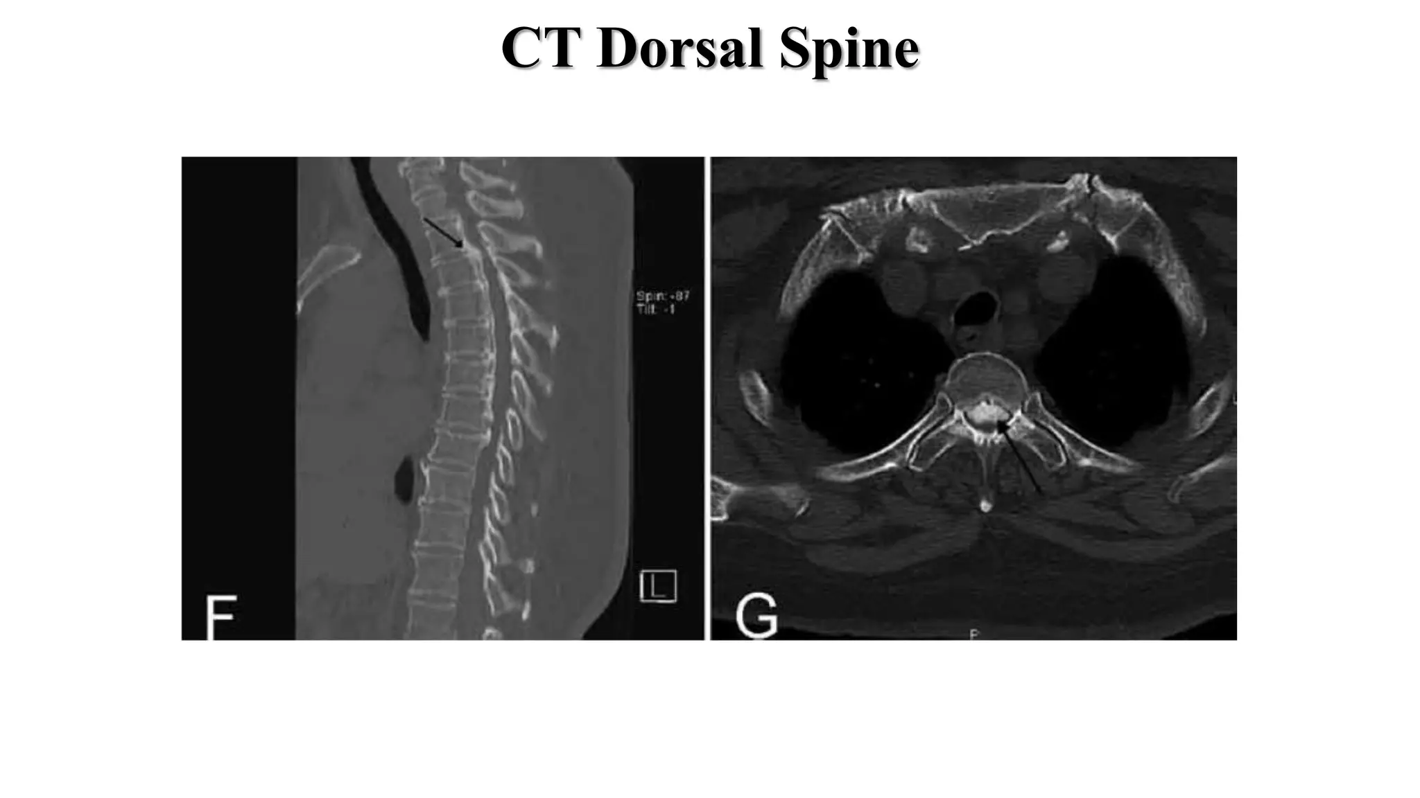 Ossified Posterior Longitudinal Ligament (OPLL) | PPTX