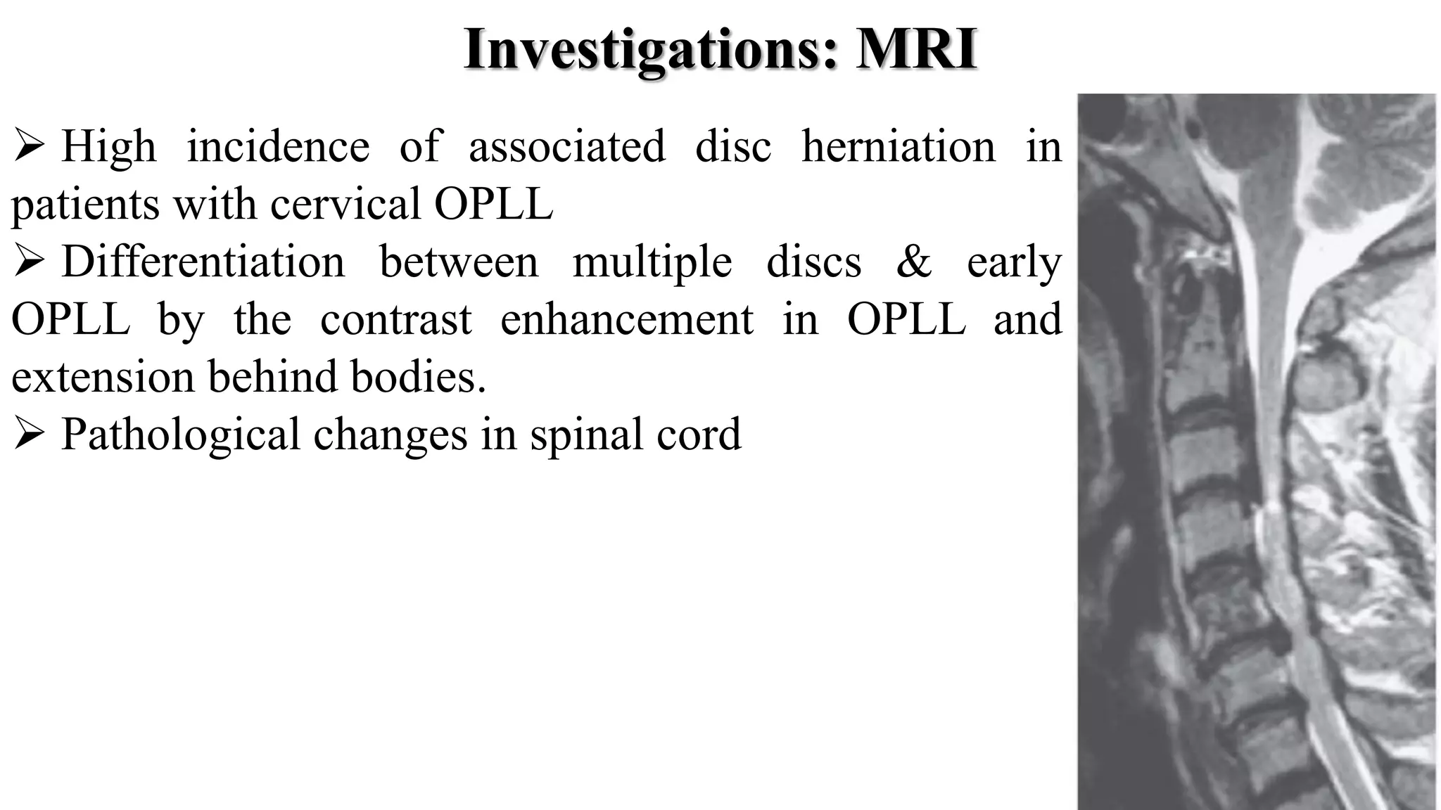 Ossified Posterior Longitudinal Ligament (OPLL) | PPTX
