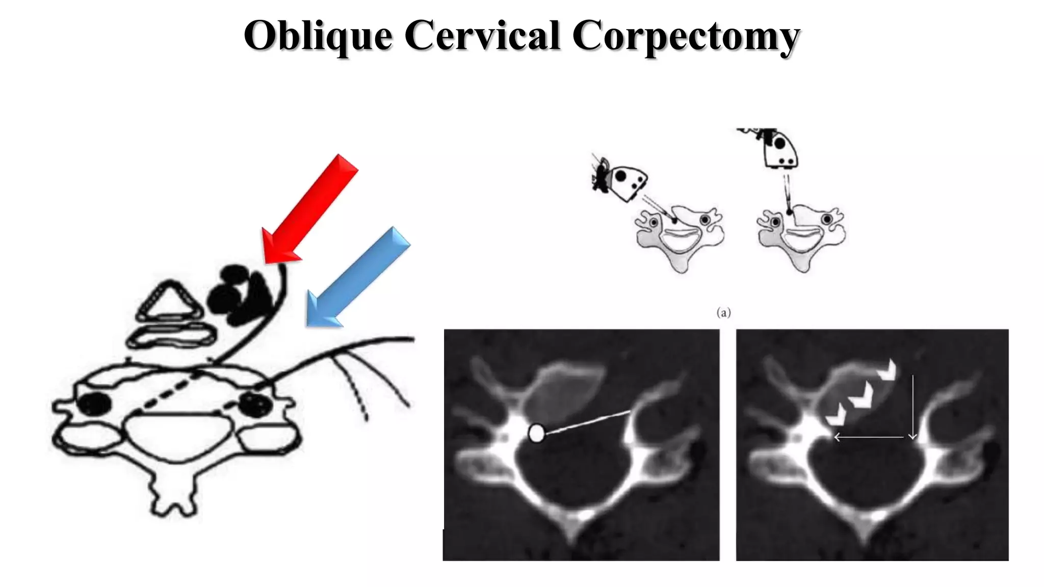Ossified Posterior Longitudinal Ligament (OPLL) | PPTX