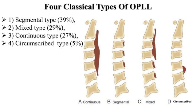 Ossified Posterior Longitudinal Ligament (OPLL) | PPTX | Bone and Joint ...