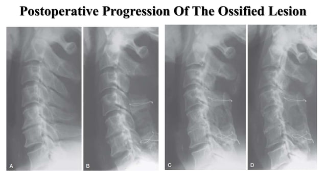 Ossified Posterior Longitudinal Ligament (OPLL) | PPTX | Bone and Joint ...