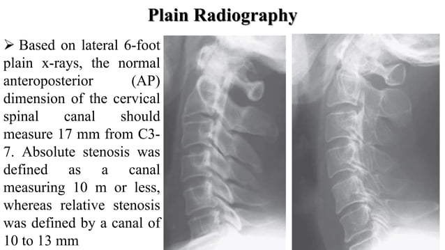 Ossified Posterior Longitudinal Ligament (OPLL) | PPTX | Bone and Joint ...