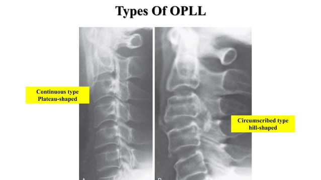 Ossified Posterior Longitudinal Ligament (OPLL) | PPTX | Bone and Joint ...