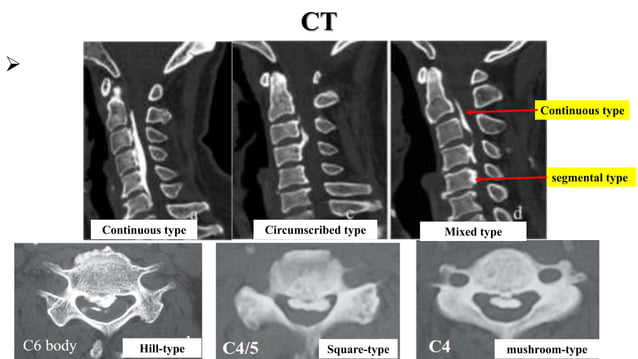 Ossified Posterior Longitudinal Ligament (OPLL) | PPTX | Bone and Joint ...