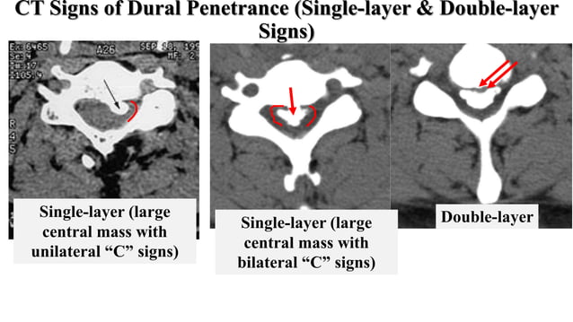 Ossified Posterior Longitudinal Ligament (OPLL) | PPTX | Bone and Joint ...