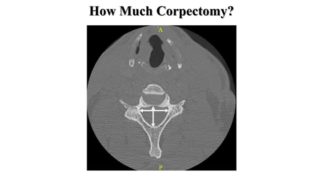 Ossified Posterior Longitudinal Ligament (OPLL) | PPTX | Bone and Joint ...