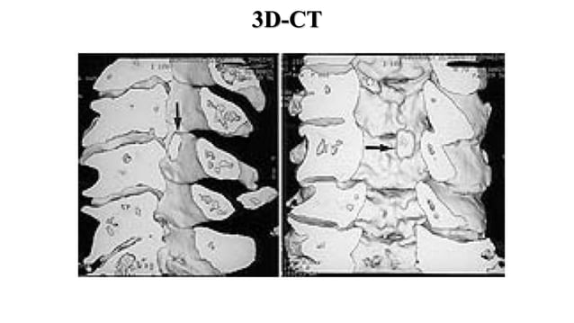 Ossified Posterior Longitudinal Ligament (OPLL) | PPTX | Bone and Joint ...