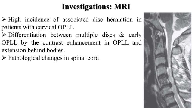 Ossified Posterior Longitudinal Ligament (OPLL) | PPTX | Bone and Joint ...
