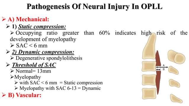 Ossified Posterior Longitudinal Ligament (OPLL) | PPTX | Bone and Joint ...