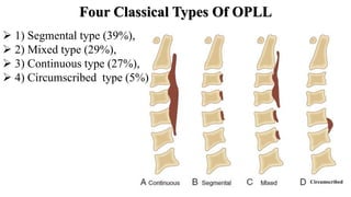 Ossified Posterior Longitudinal Ligament (OPLL) | PPT