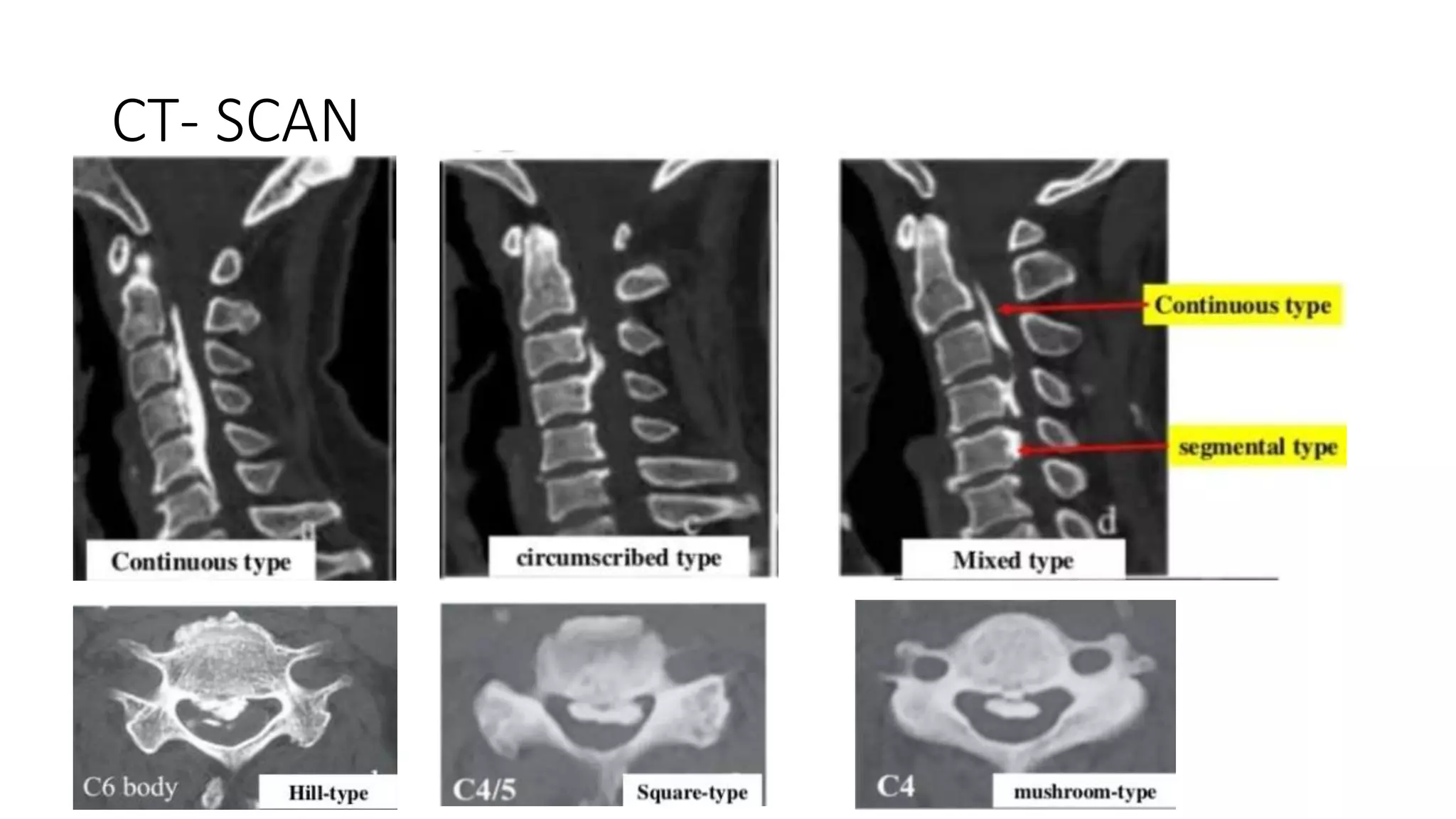 OPLL - SPINE | PPTX