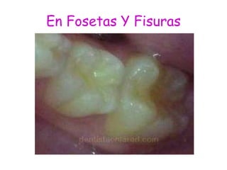 Placa dentobacteriana | PPTX