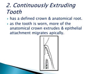 Mechanisms of Tooth Eruption & Mammalian Teeth 3 Categories on the ...
