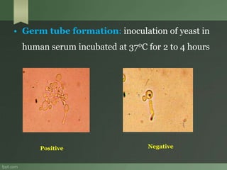 Opportunistic fungal infection | PPTX