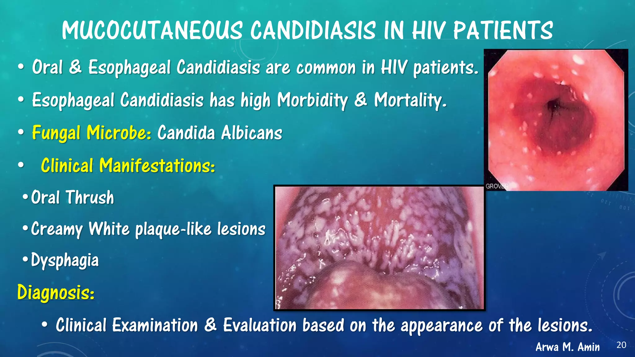 Opportunistic Infections in HIV | PDF