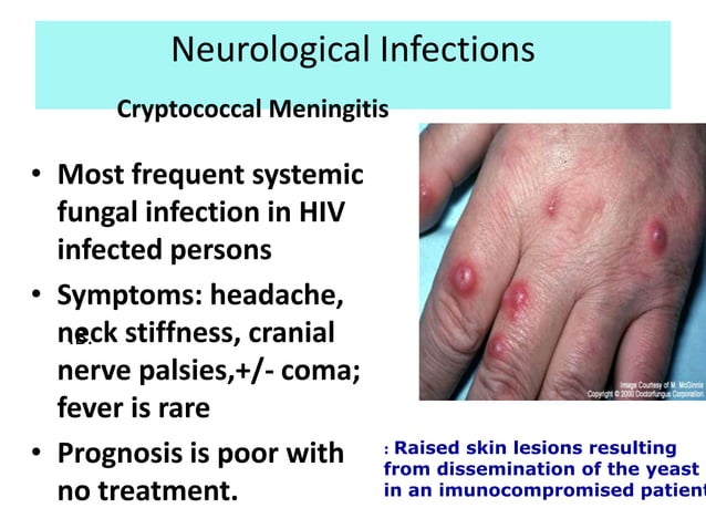 Opportunistic infections (oi) deepa | PPTX | Infectious Diseases ...