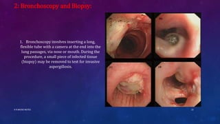 Opportunistic mycoses ASPERGILLOSiS .pptx