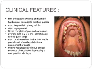 Median Palatal Cyst