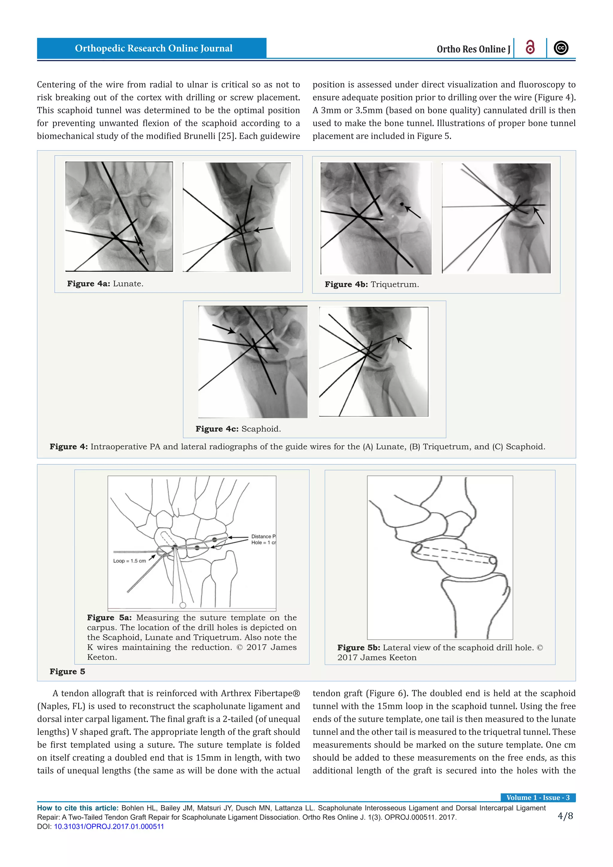Crimson Publishers-Scapholunate Interosseous Ligament and Dorsal ...