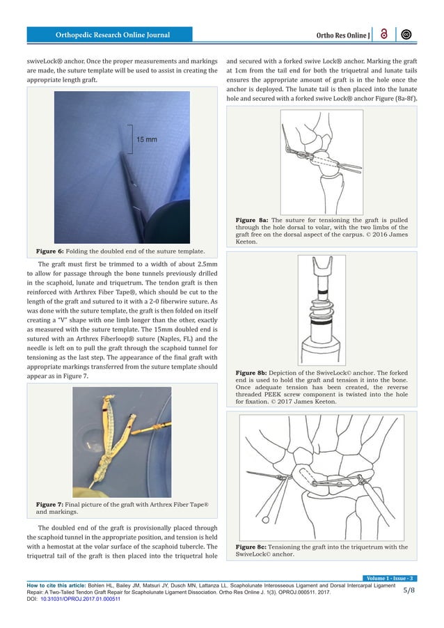 Crimson Publishers-Scapholunate Interosseous Ligament and Dorsal ...