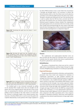 Crimson Publishers-Scapholunate Interosseous Ligament and Dorsal ...