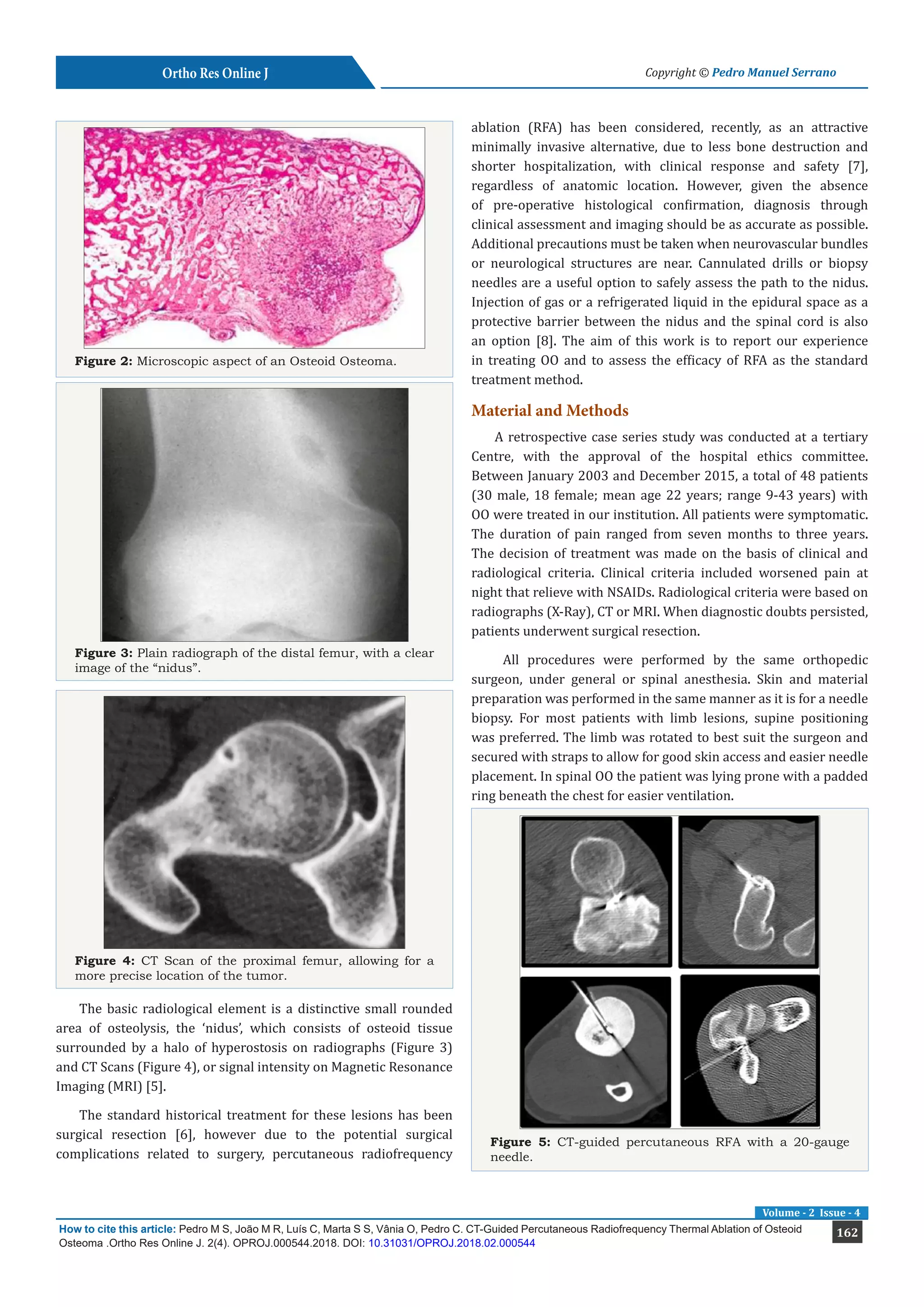CT-Guided Percutaneous Radiofrequency Thermal Ablation of Osteoid ...