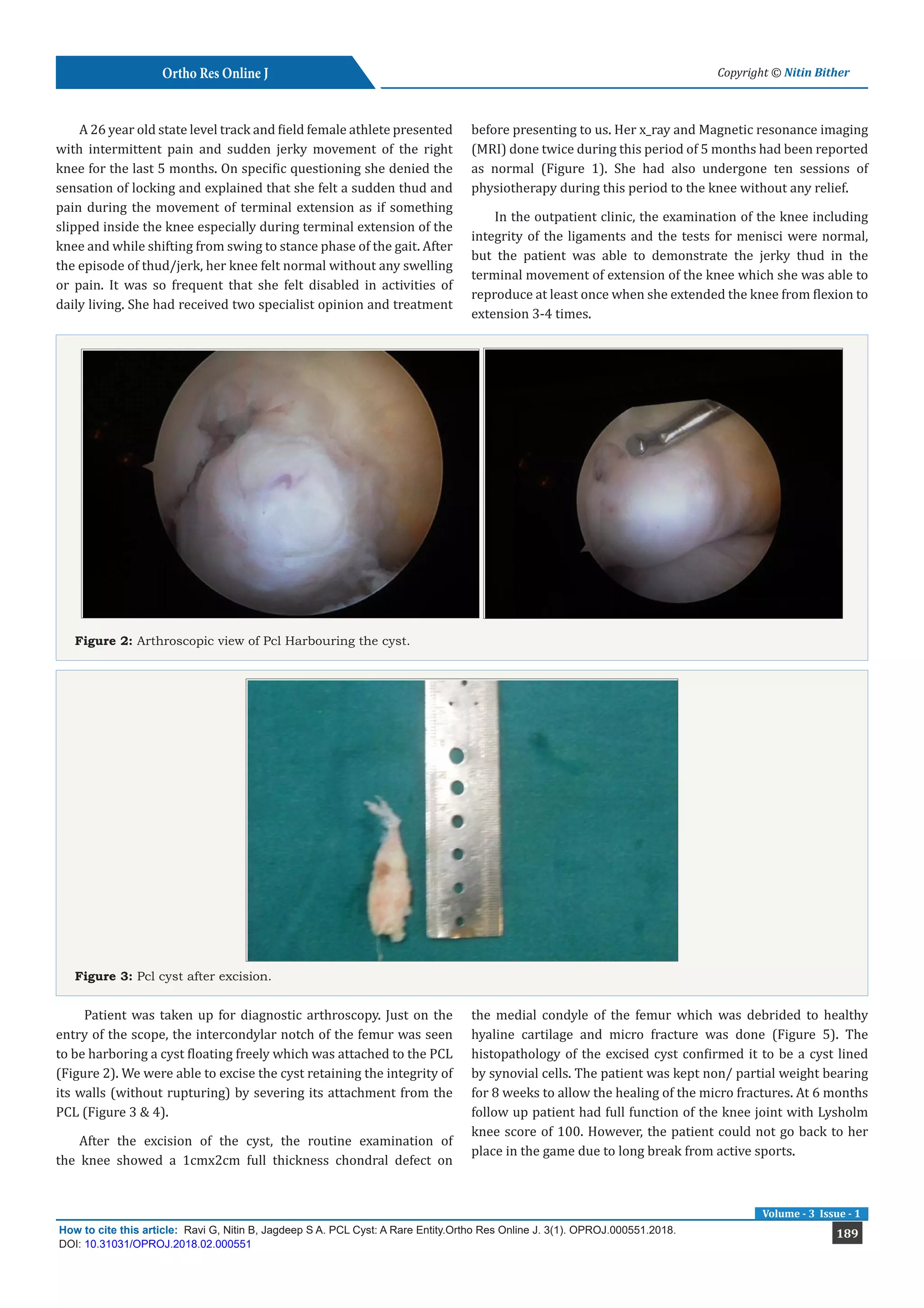 Pcl Cyst A Rare Entity Crimson Publishers Pdf