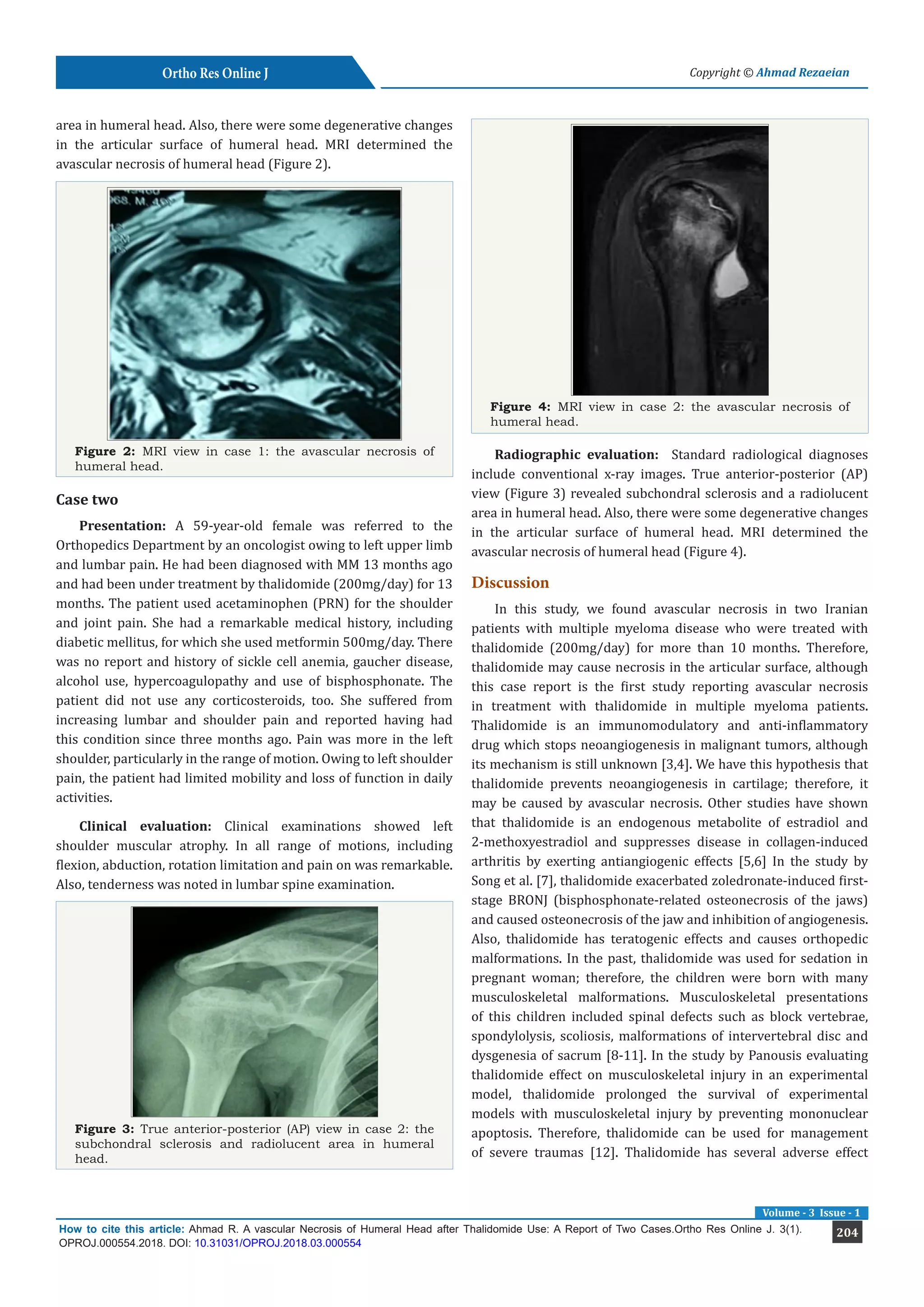 Avascular Necrosis of Humeral Head after Thalidomide Use: A Report of ...
