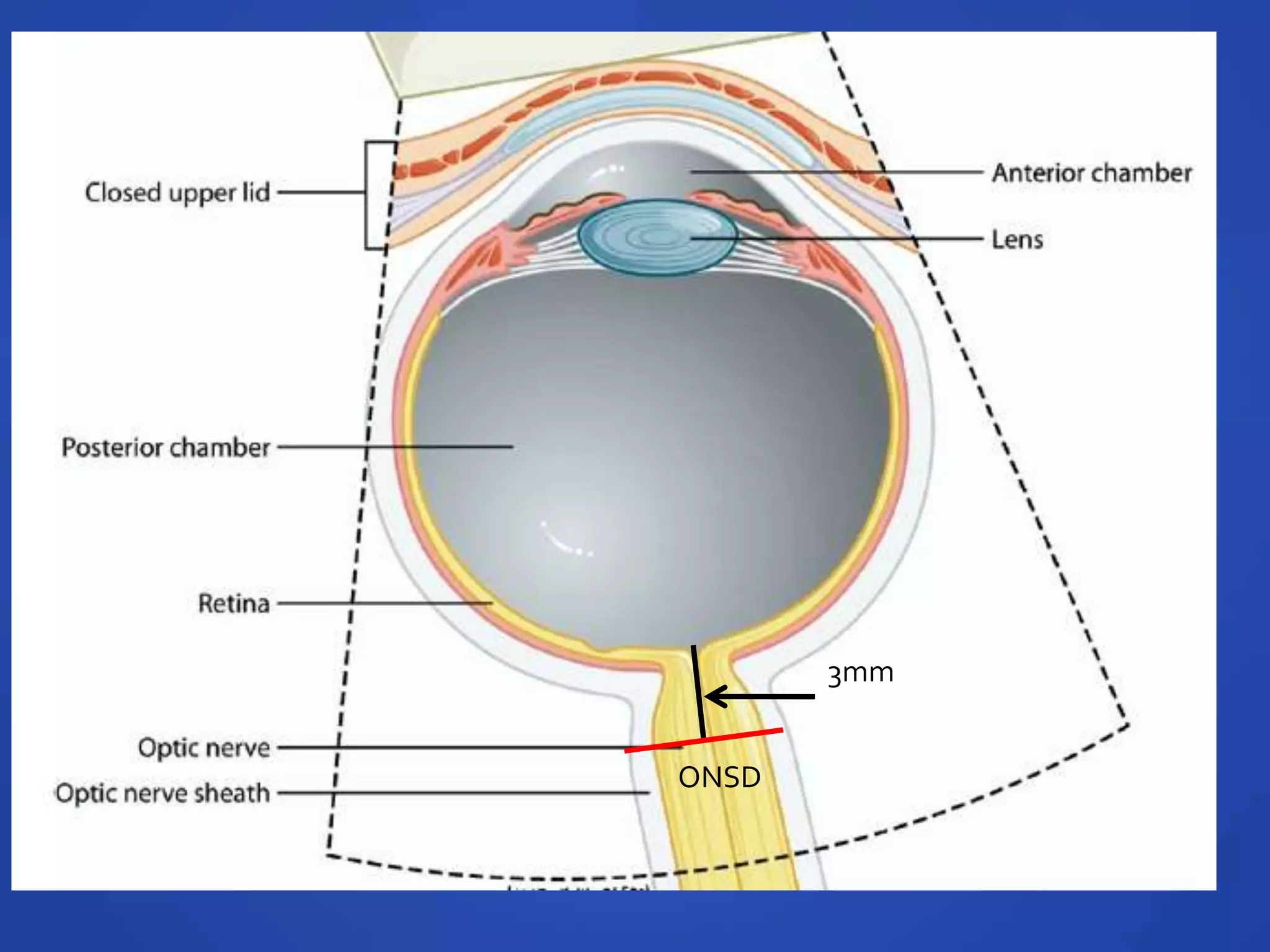 Oprtic1.nerve sheath | PPTX
