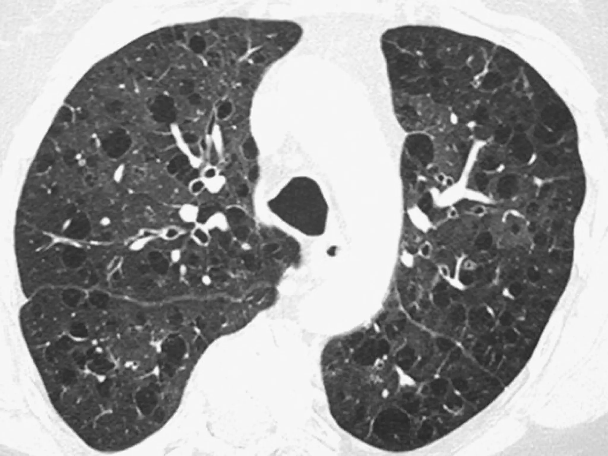 TCAR de tórax: Princípios Básicos | PPT | Lung and Respiratory Health ...