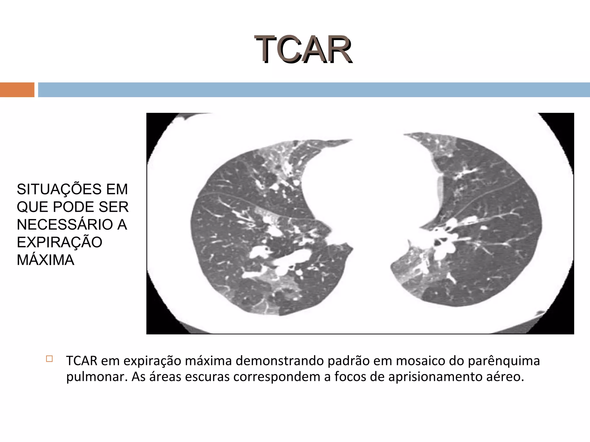 TCAR de tórax: Princípios Básicos | PPT