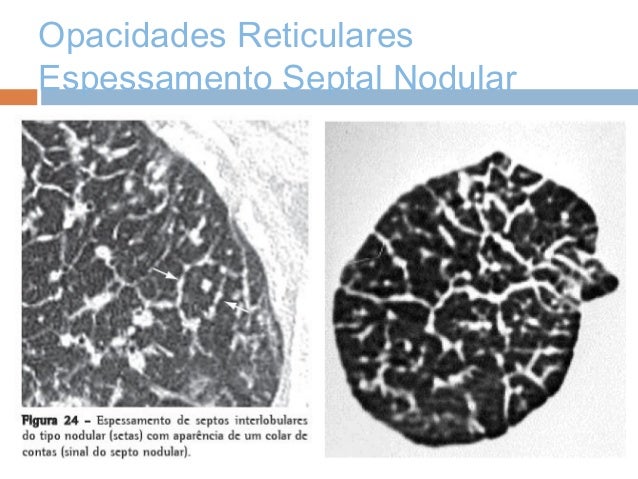 TCAR de tórax: Princípios Básicos