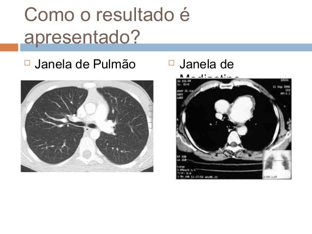 TCAR de tórax: Princípios Básicos