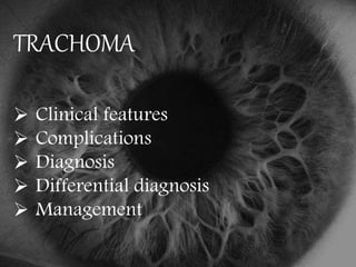 Trachoma | PPTX
