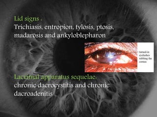 Trachoma | PPTX