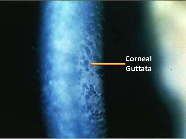 Corneal Degeneration's, Ophthalmology