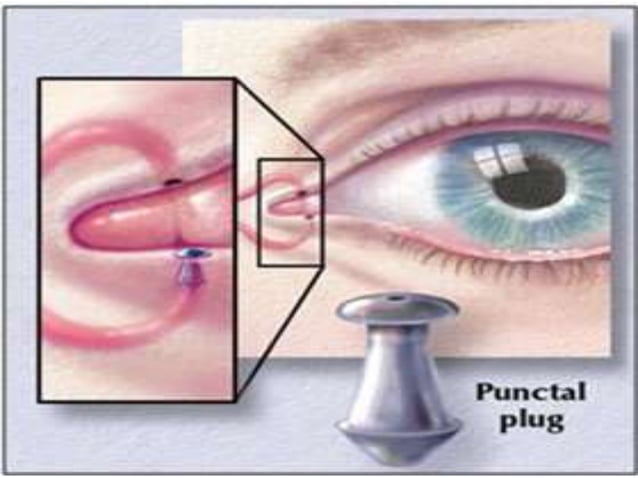 Opthalmic route of administration | PPTX | Eye and Vision Conditions ...